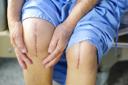 Meniscus Surgery in Houston, TX | Barrett S. Brown, MD